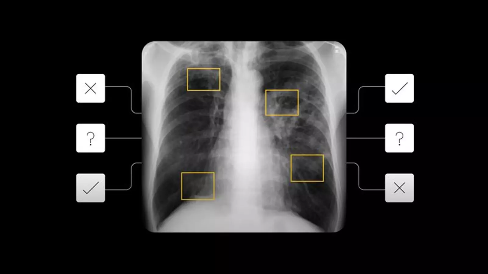 谷歌的人工智能技术帮助筛查结核病 X 光片