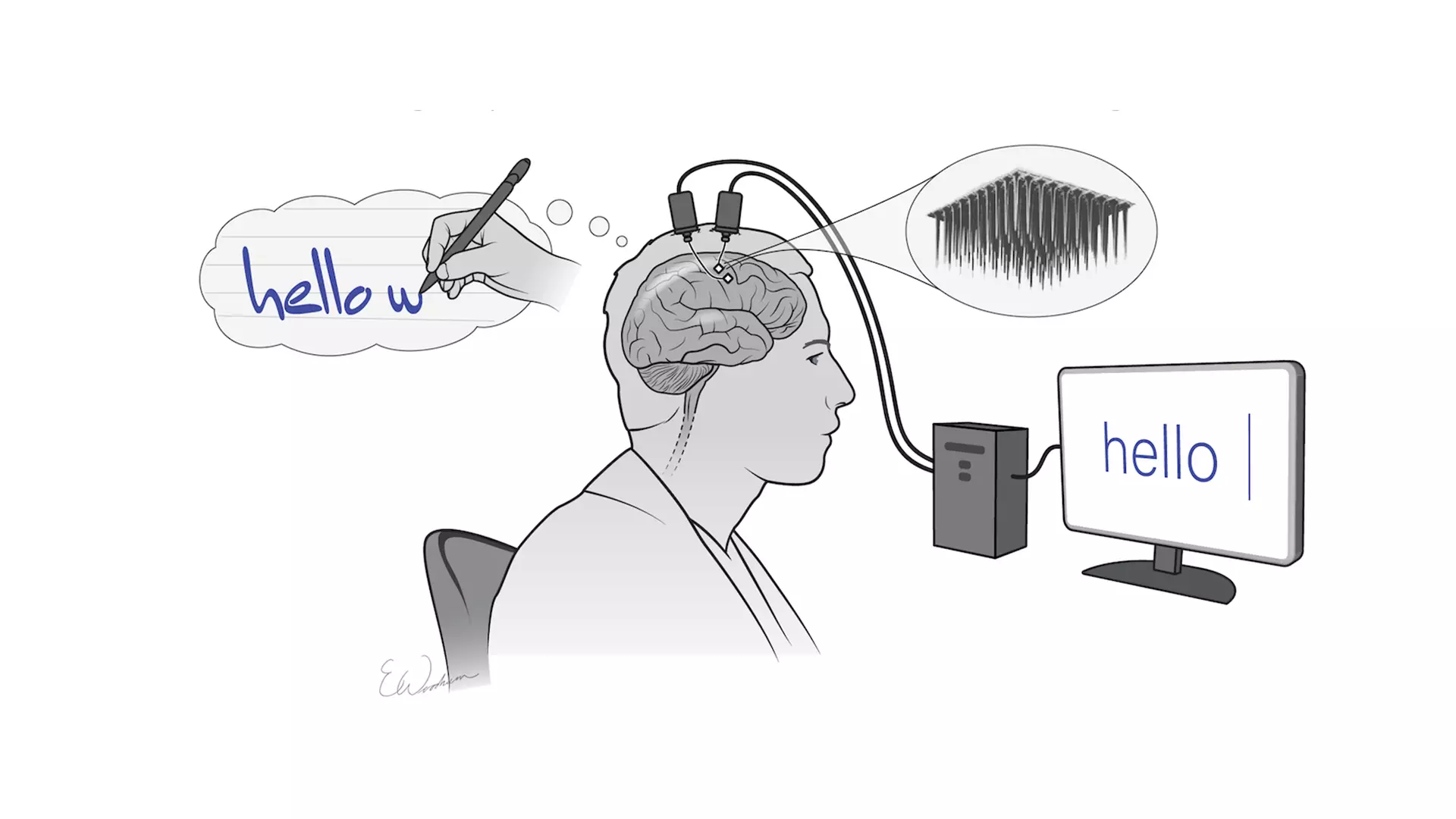 एक मस्तिष्क प्रत्यारोपण ने एक लकवाग्रस्त व्यक्ति को विचार को पाठ में बदलने में मदद की